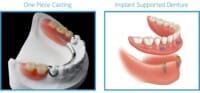 Types of Dentures & Price Philippines | Dental World Manila